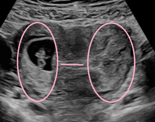 Abnormal Uterus Shapes What You Need To Know The Ultrasound Suitethe
