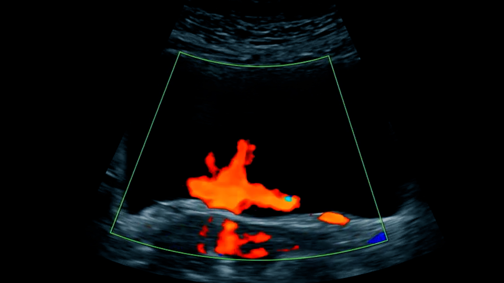Abdomen and Pelvis Ultrasound - The Ultrasound Suite