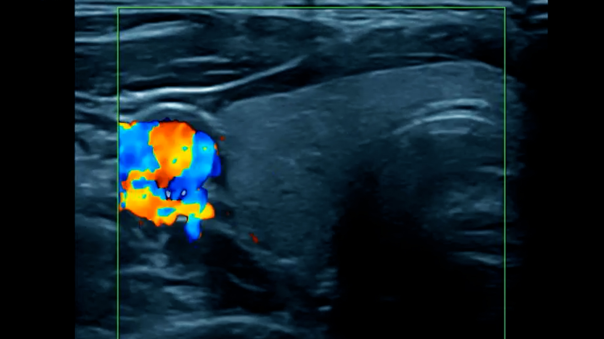 Thyroid Ultrasound The Ultrasound Suite