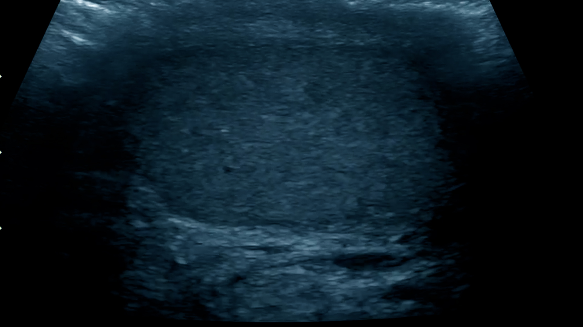 Testicular Ultrasound The Ultrasound Suite